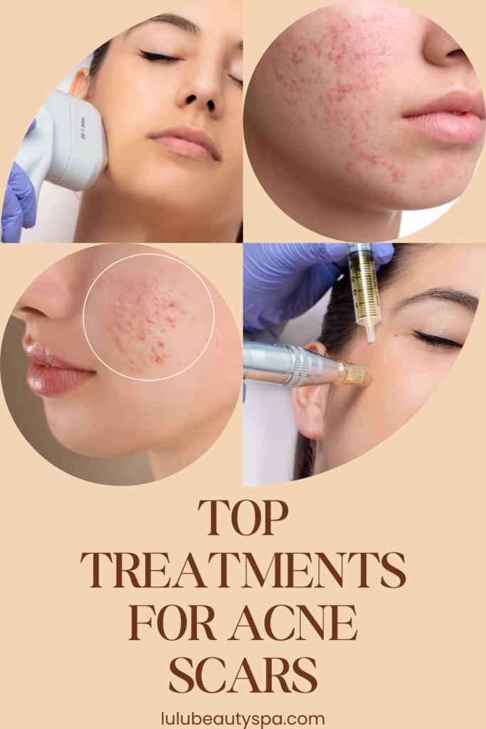 Best Facial for Acne Scars: Top Treatments for Scarring - Lulu Beauty Spa