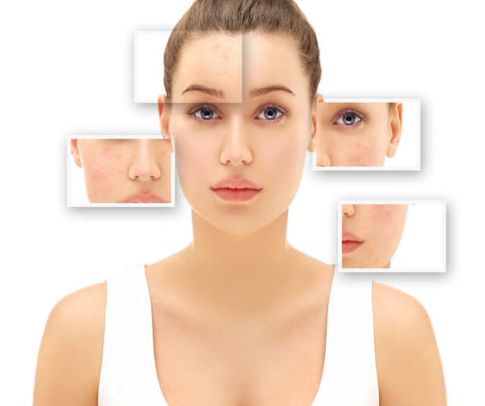 Best Facial for Acne Scars: Top Treatments for Scarring - Lulu Beauty Spa
