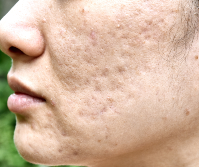 Best Facial for Acne Scars: Top Treatments for Scarring - Lulu Beauty Spa