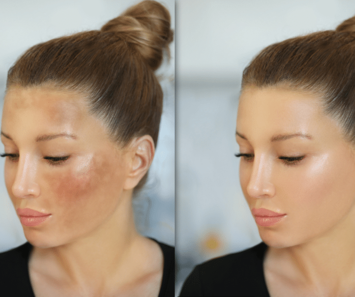 ¿Ayuda el Microneedling a la Melasma? Detalles que Necesitas Saber ...