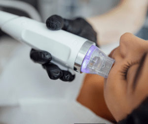 Does Microneedling Help Melasma? Details You Need to Know - Lulu Beauty Spa