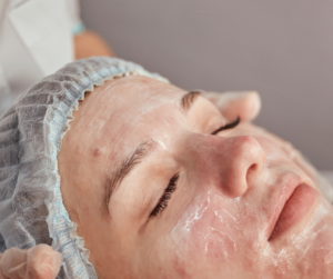 Acne Scabs Treatment: How to Get Rid of Scarring - Lulu Beauty Spa