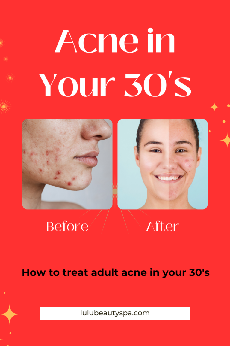 Adult Acne at 30 Years Old: Causes & How to Treat It - Lulu Beauty Spa
