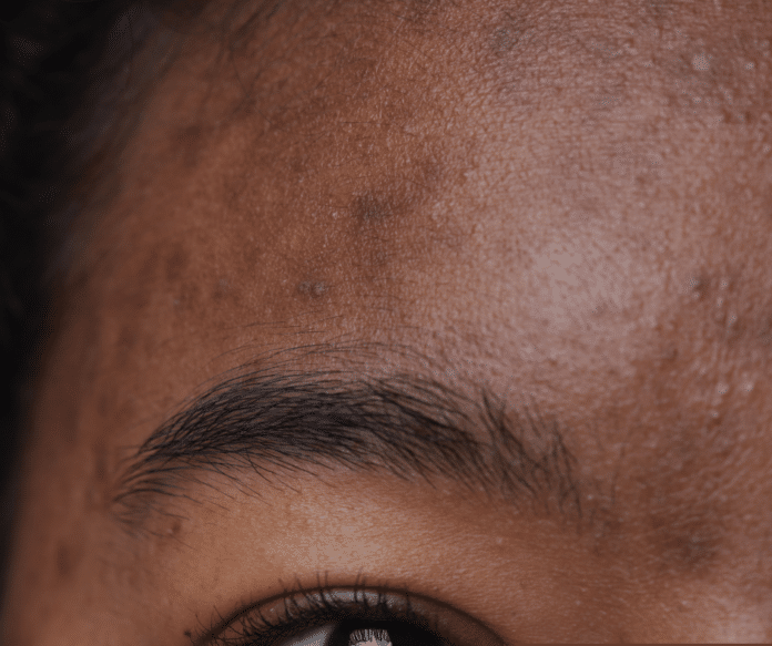 Does Dry Skin Cause Acne? How to Treat Both at the Same Time - Lulu ...